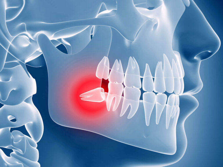 Rockdale Dental Office TX| Wisdom Teeth and Sinus Problems Solution