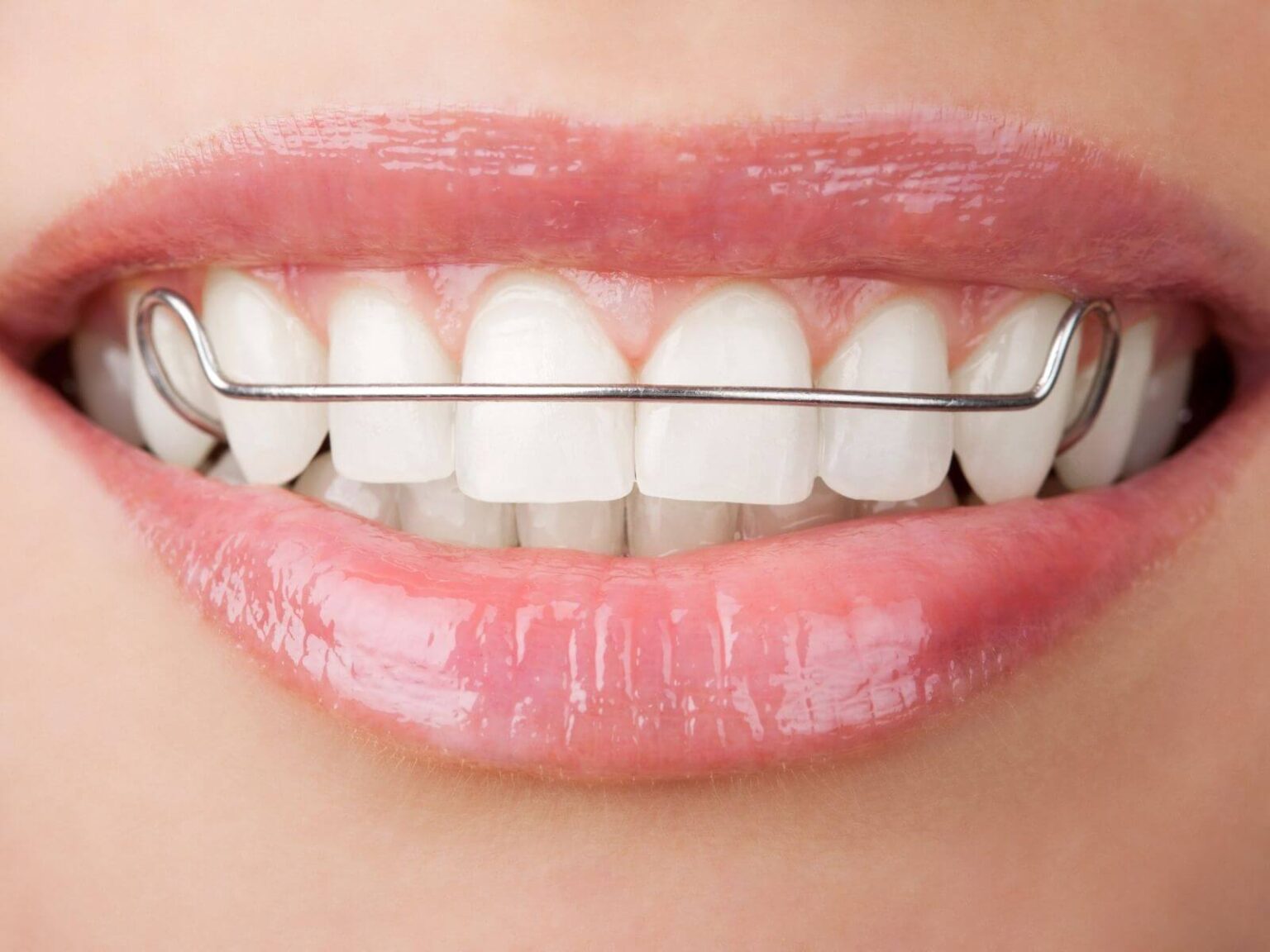 Do Retainers Help Straighten Your Teeth