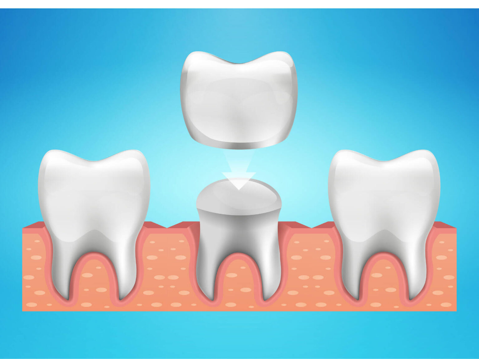 Tooth Crown Procedure: Step-by-Step Guide