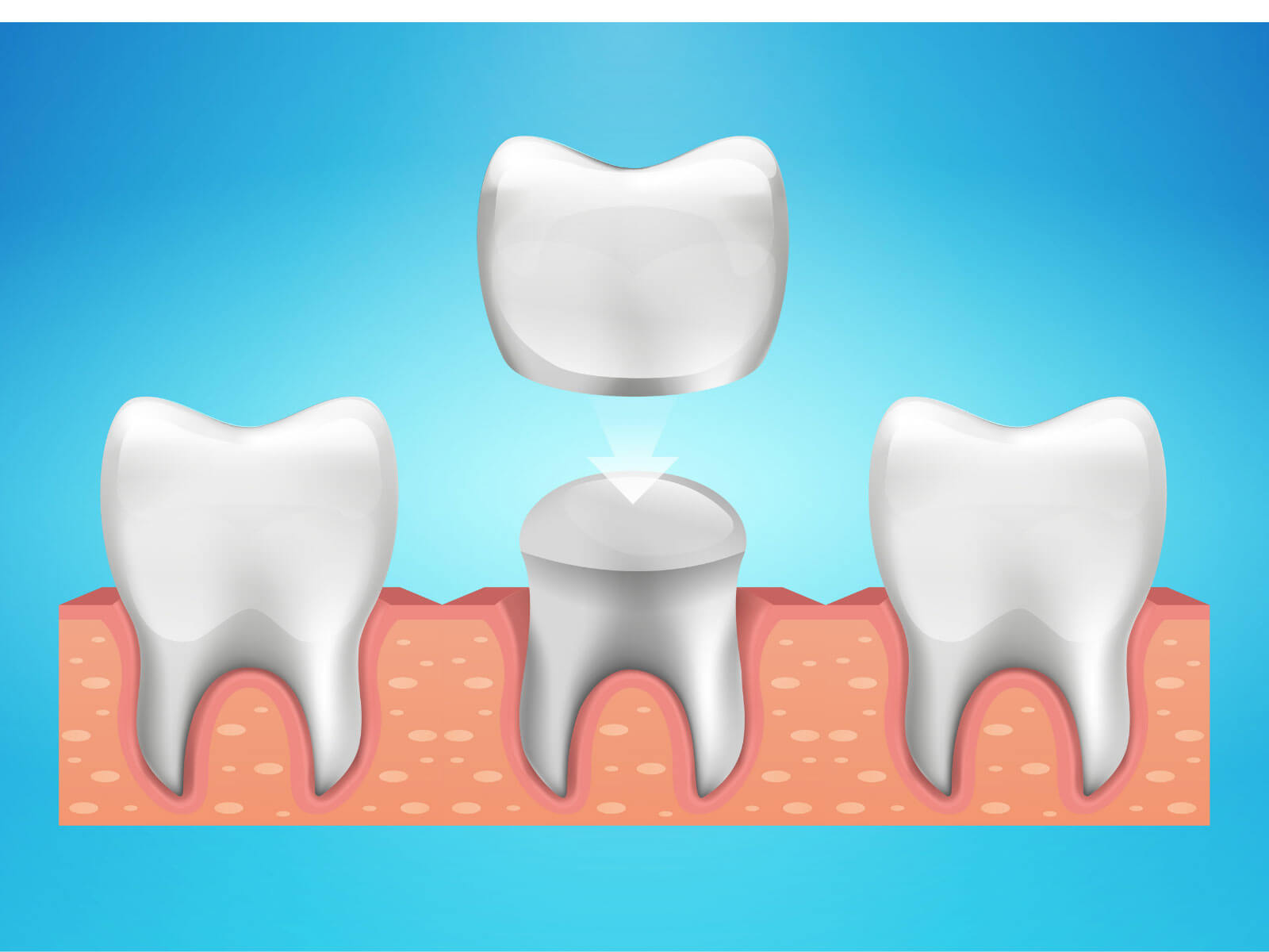 Tooth Crown Procedure: Step-by-Step Guide